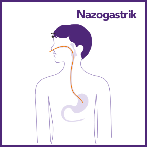 Tüp yoluyla beslenme 1,3